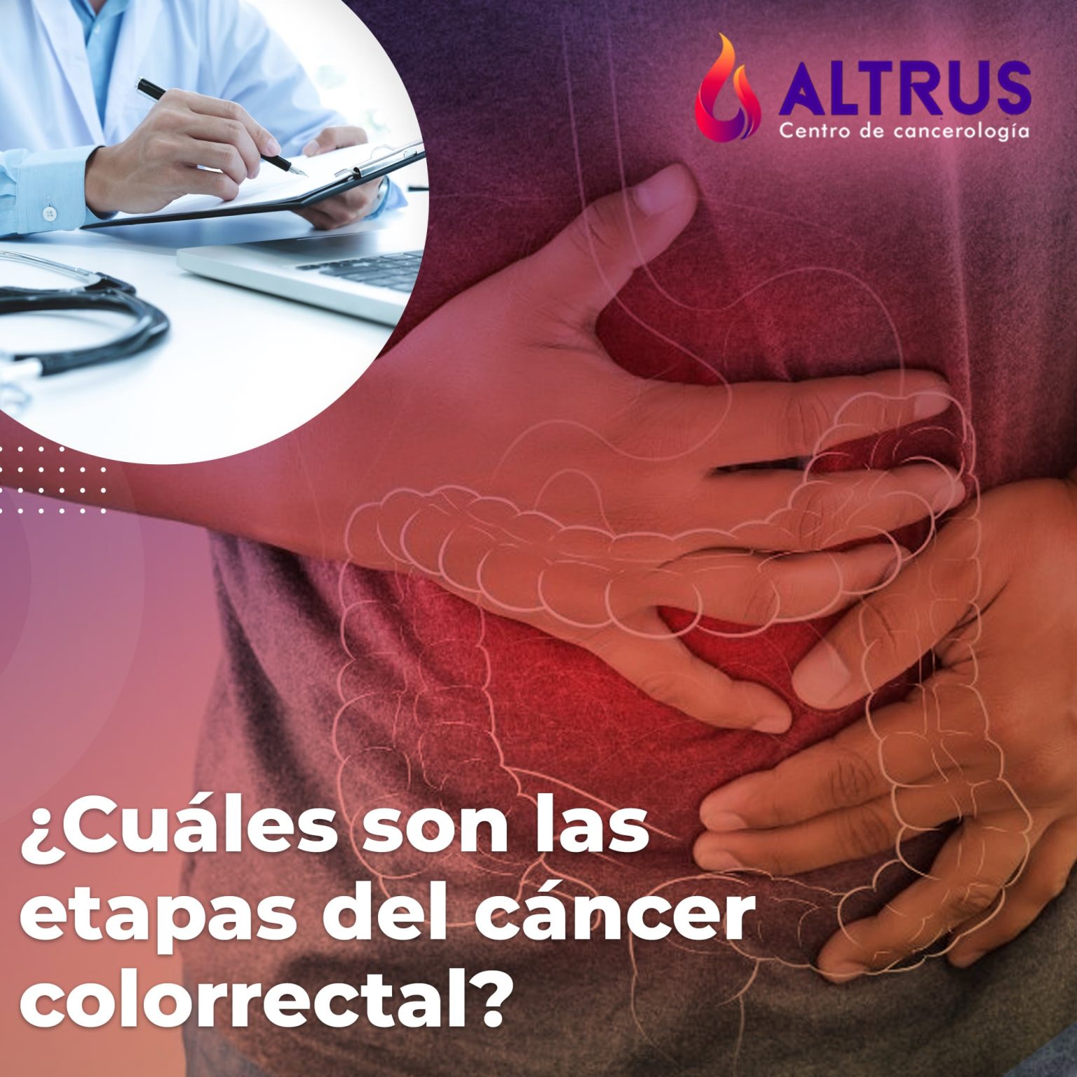 ¿Cuales son las etapas del cáncer colorrectal? | Altrus Cancerología
